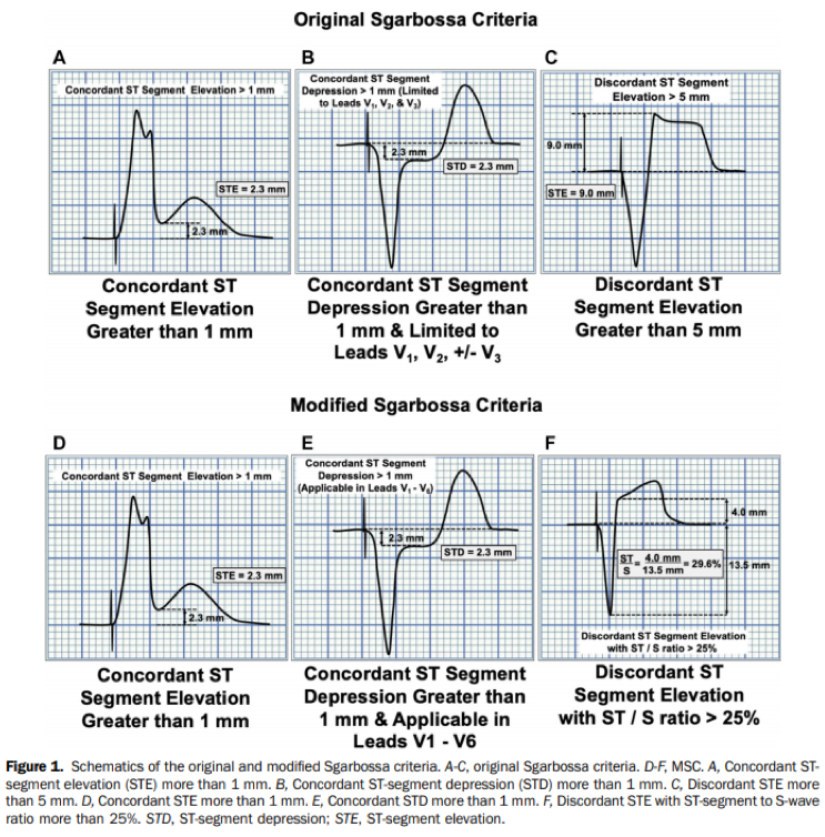 Modified Sgarbossa Criteria – EMCY